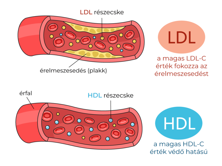 Magas LDL-koleszterin: okok, tünetek, kezelés